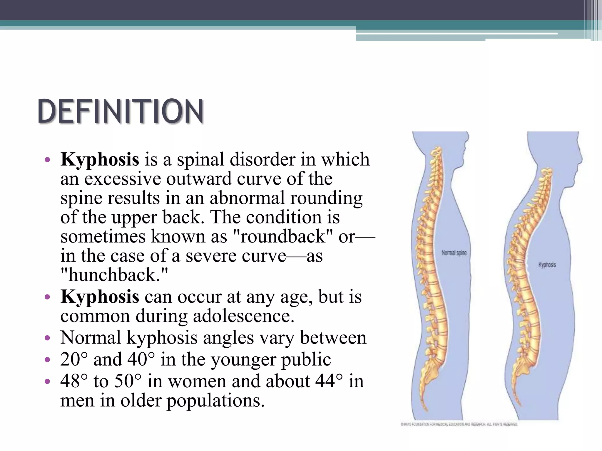Kyphosis | PPTX