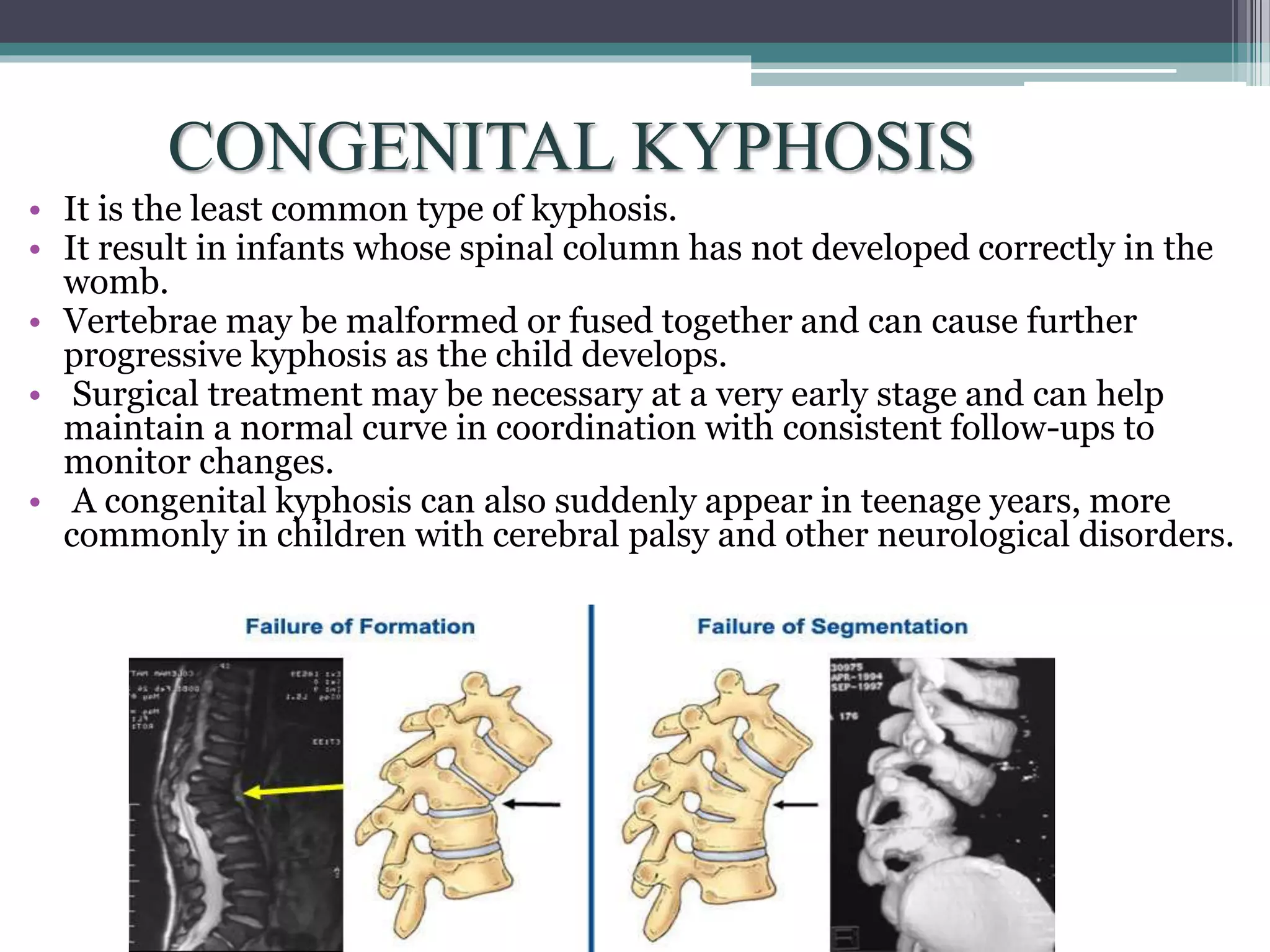 Kyphosis | PPT
