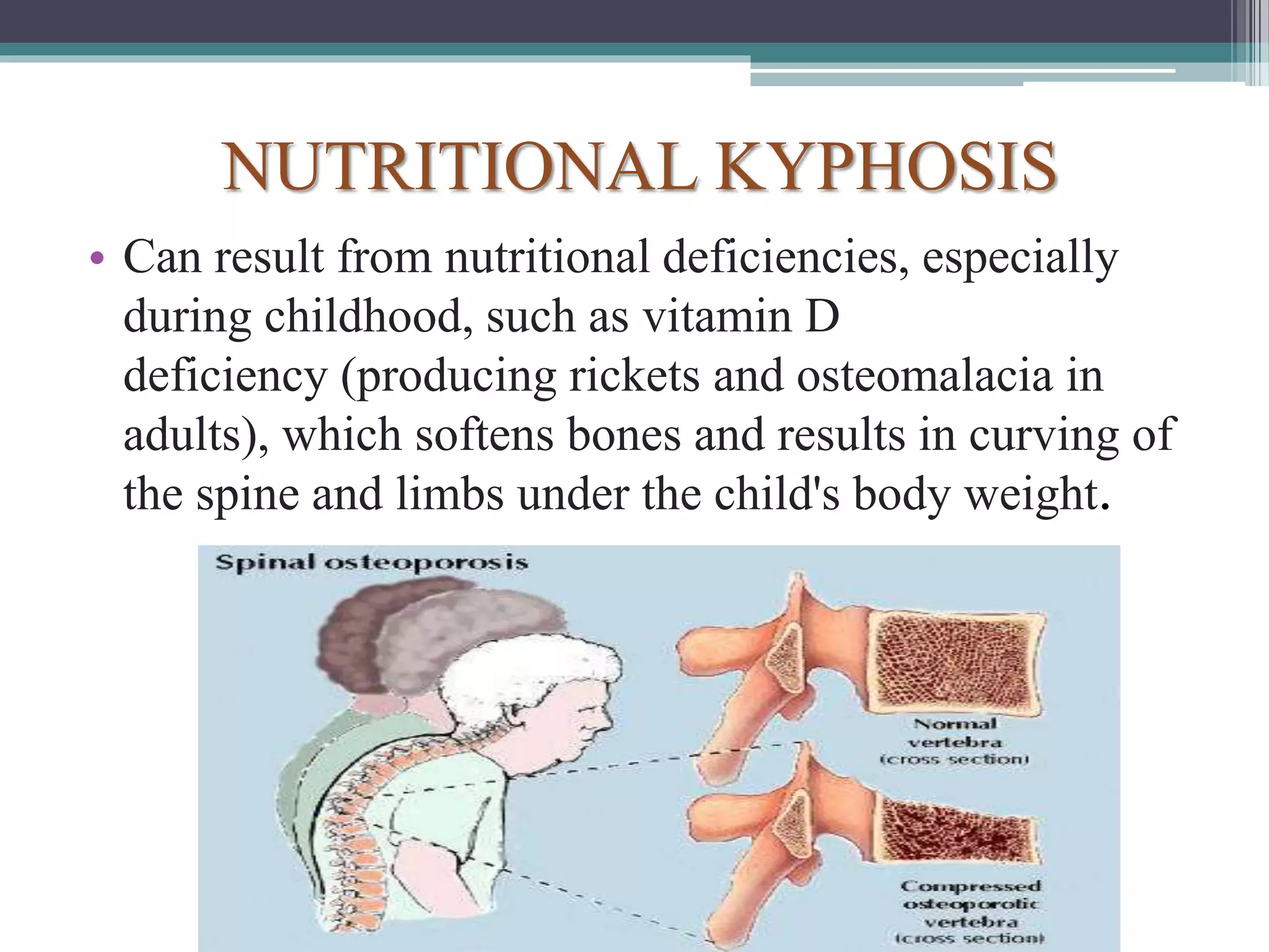 Kyphosis | PPTX
