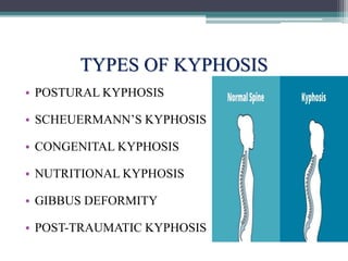Kyphosis | PPTX