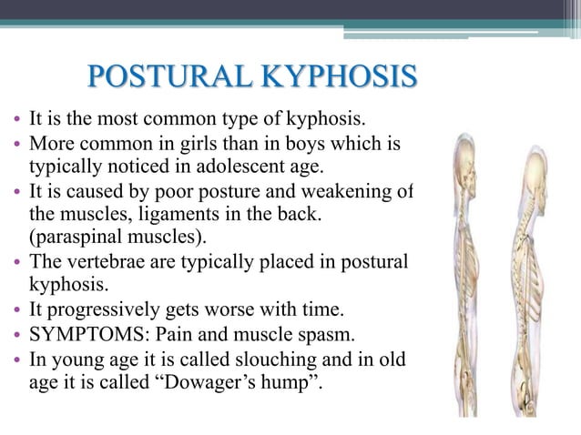Kyphosis | PPT