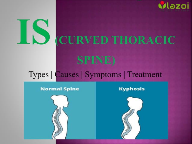 Kyphosis.pptx
