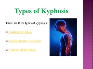 Kyphosis.pptx