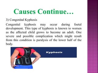 Kyphosis.pptx