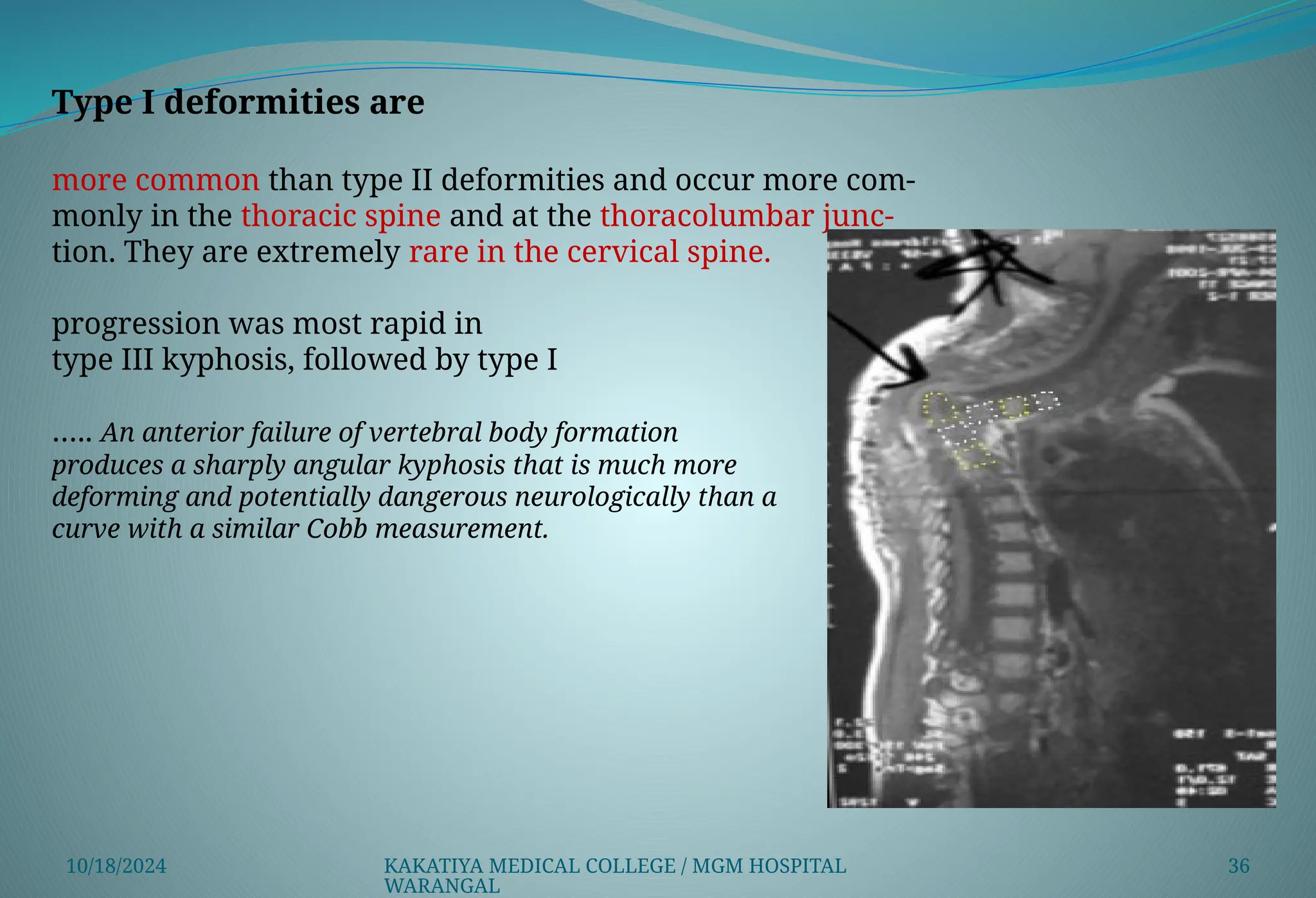 KYPHOSIS.pptx KYPHOSIS DEFORMITY OF THE SPINE | PPTX