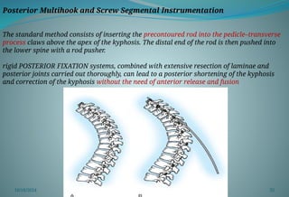 KYPHOSIS.pptx KYPHOSIS DEFORMITY OF THE SPINE | PPTX