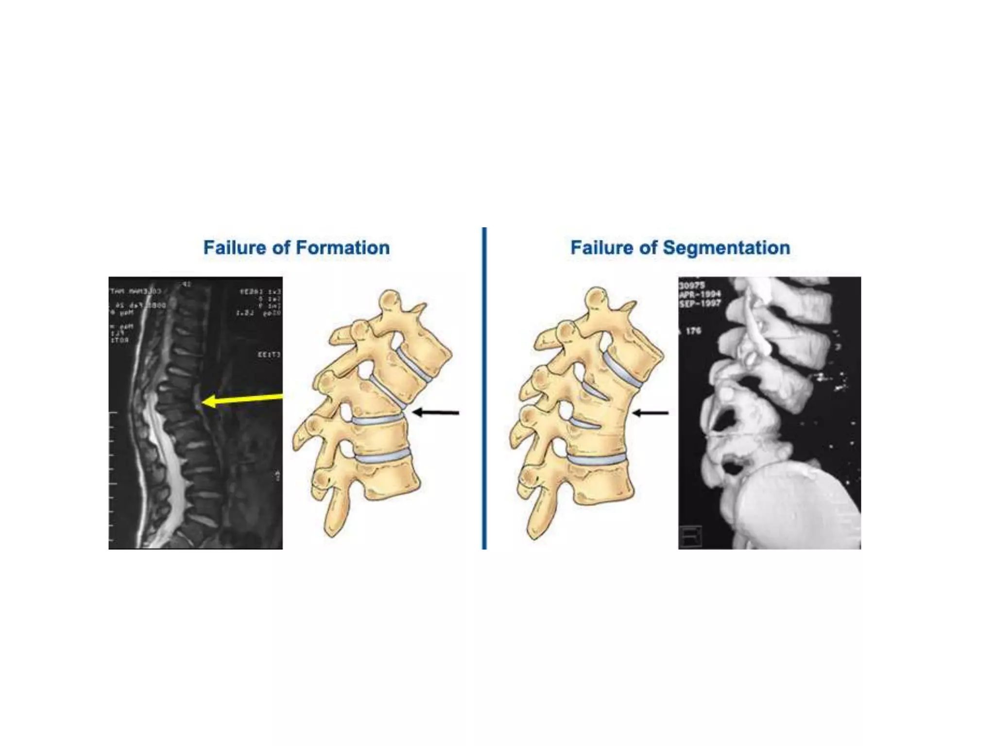 Kyphosis and Lordosis | PPTX