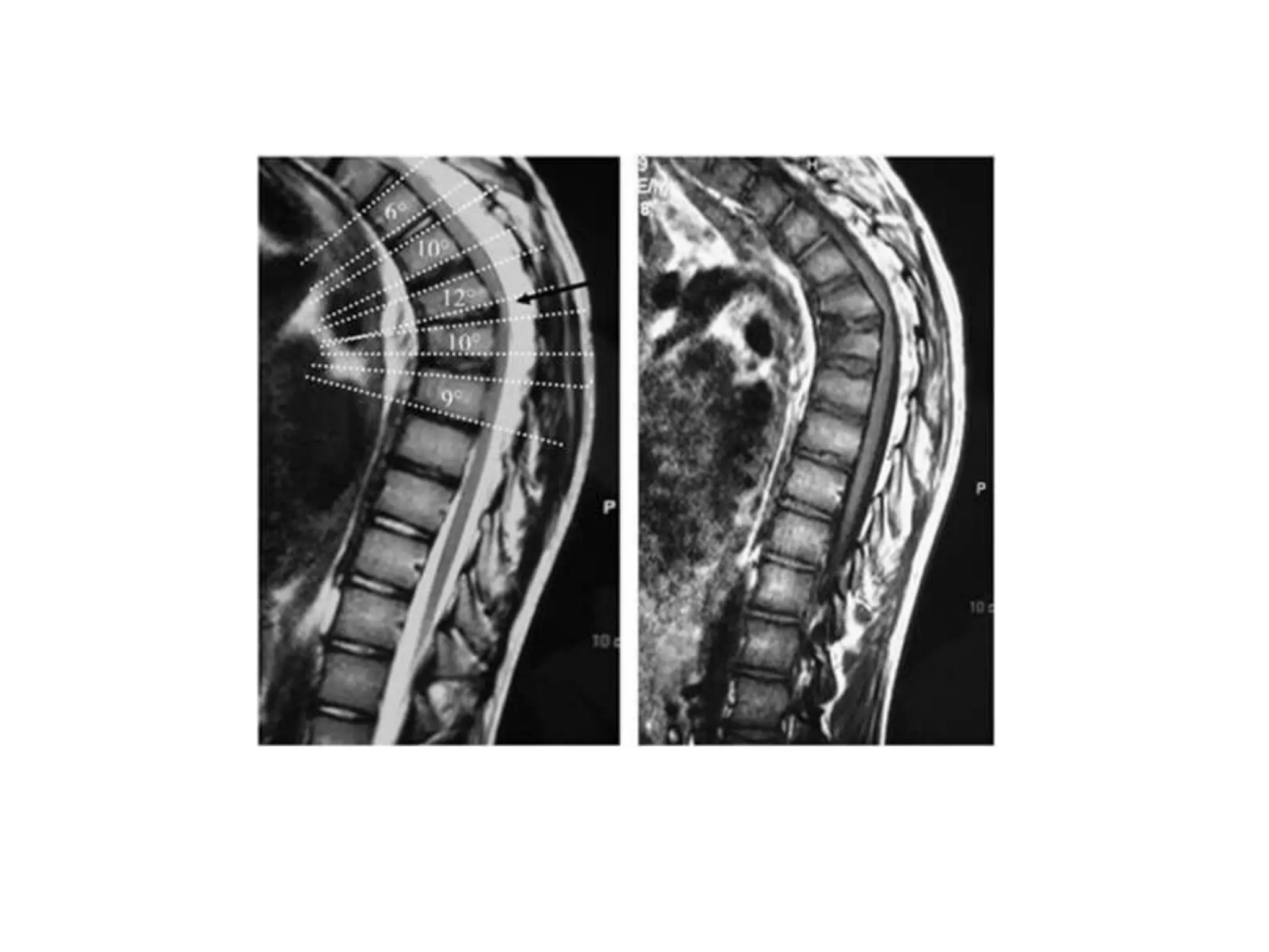 Kyphosis and Lordosis | PPTX