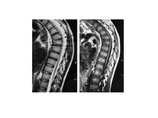 Kyphosis lordosis- | PPTX