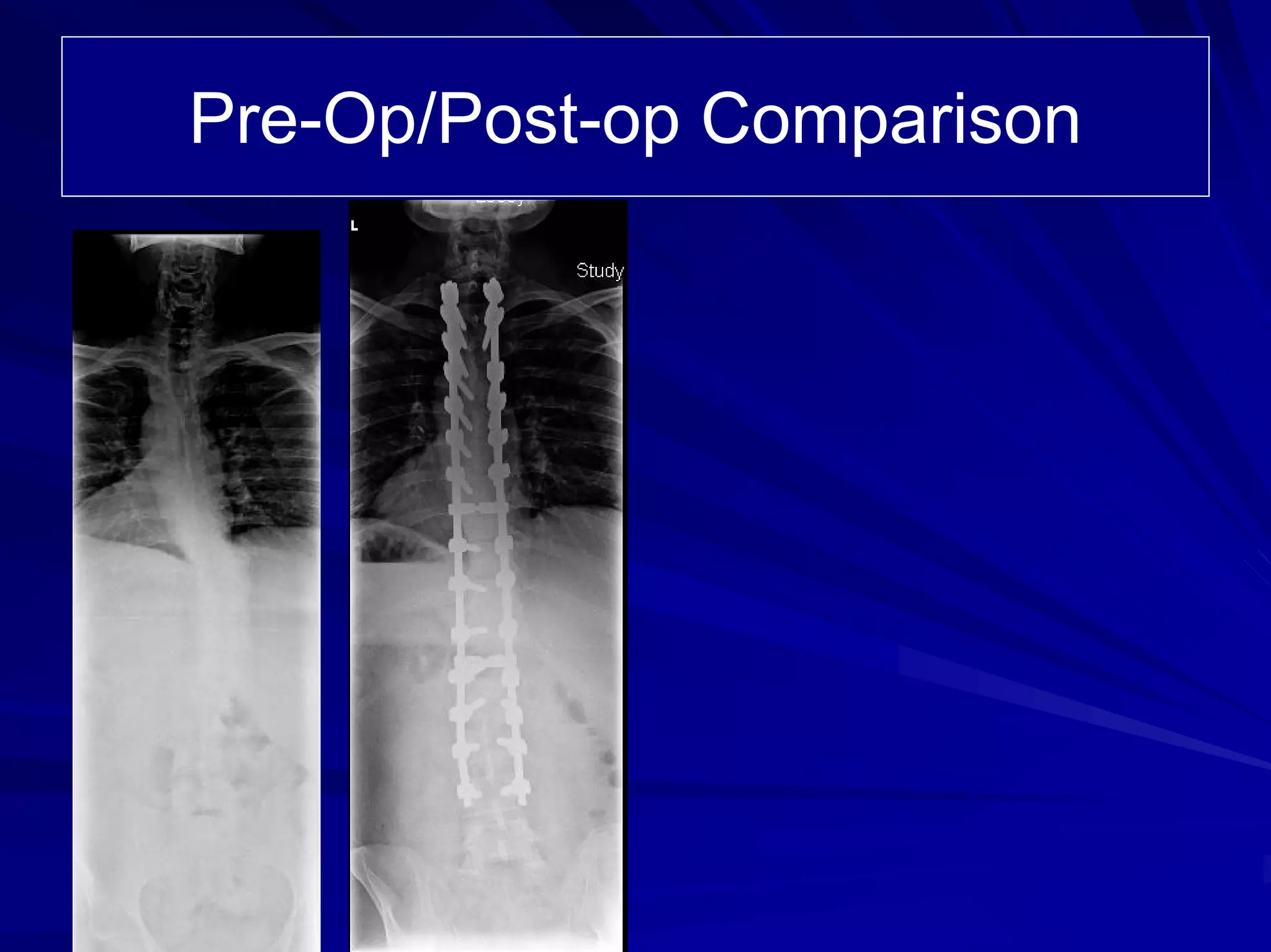 Case Review #5: 48 year old male with Scheurmann's Kyphosis | PPT