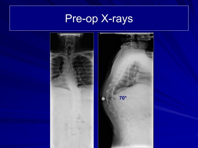 Case Review #5: 48 year old male with Scheurmann's Kyphosis | PPT
