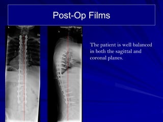 Case Review #5: 48 year old male with Scheurmann's Kyphosis | PDF