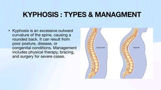 KYPHOSIS AND ITS TYPES in the physiotherapy aspects | PDF