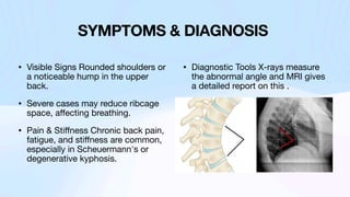 KYPHOSIS AND ITS TYPES in the physiotherapy aspects | PDF