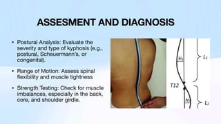 KYPHOSIS AND ITS TYPES in the physiotherapy aspects | PDF