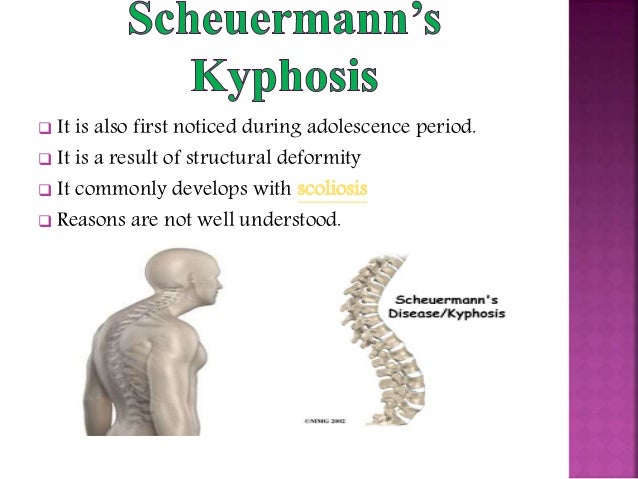 Kyphosis: Curved Thoracic Spine