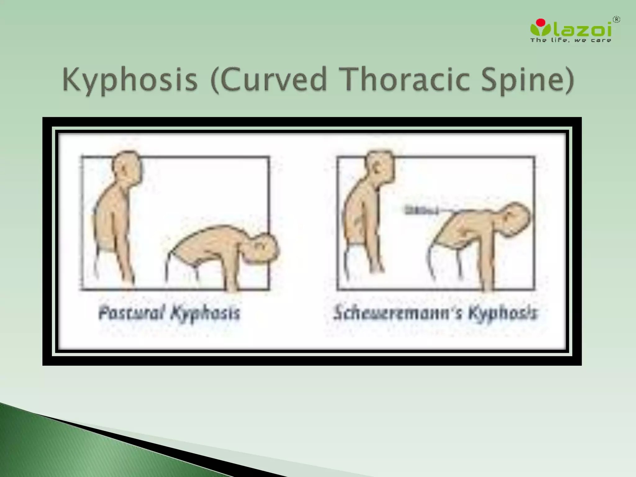 Kyphosis (curved thoracic spine) | PPTX | Physical Therapy | Wellness