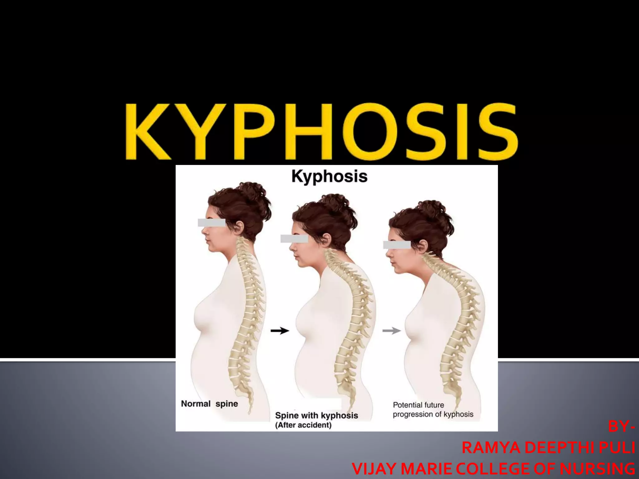 Kyphosis lordosis | PPTX | Bone and Joint Conditions | Diseases and ...