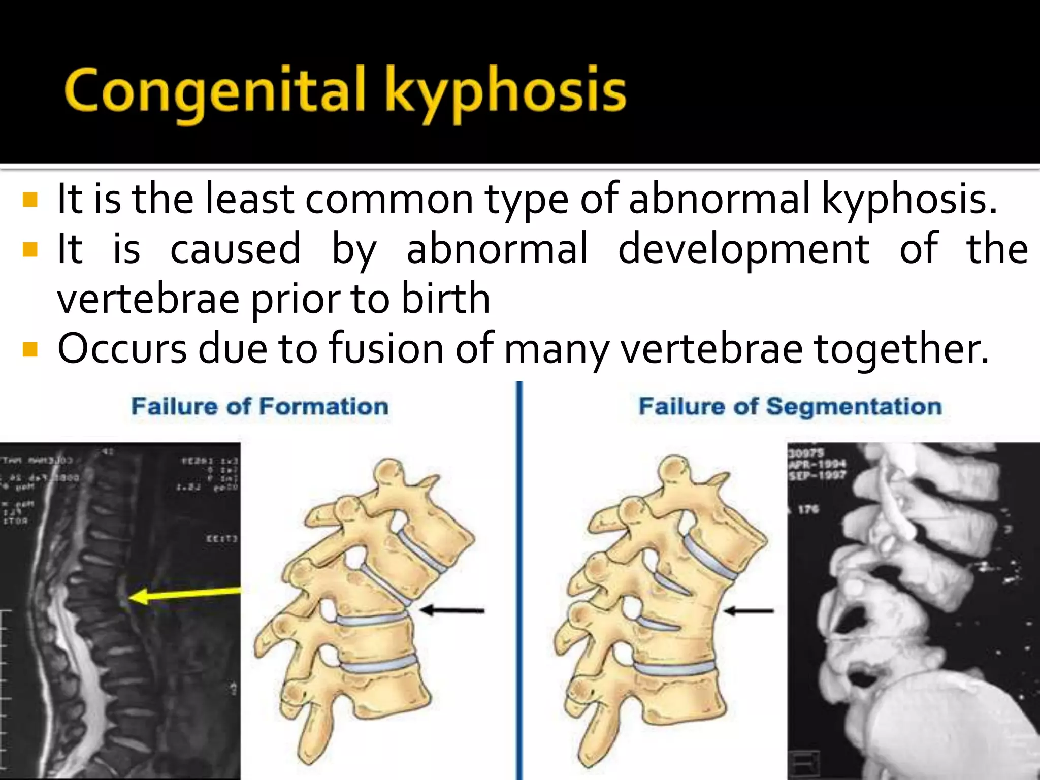 Kyphosis lordosis | PPTX