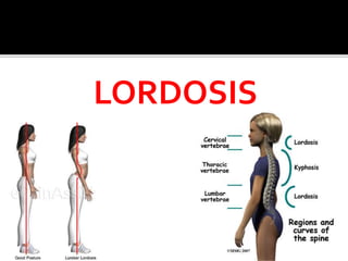Kyphosis lordosis | PPTX