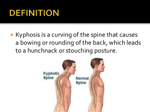 Kyphosis lordosis