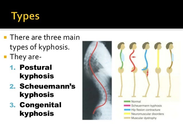 Kyphosis lordosis