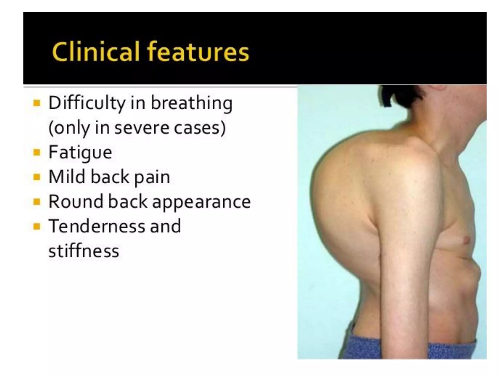 KYPHOSIS LORDOSIS.pdf