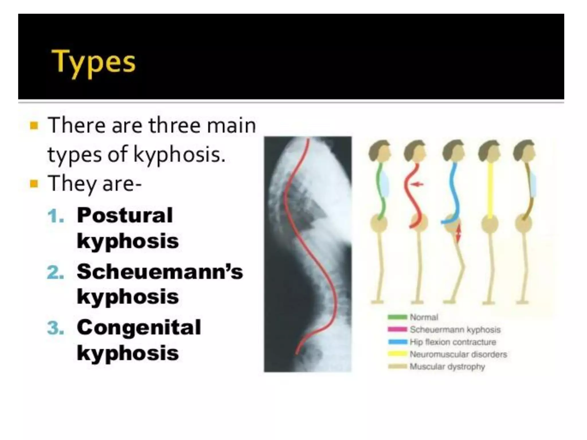 KYPHOSIS LORDOSIS.pdf