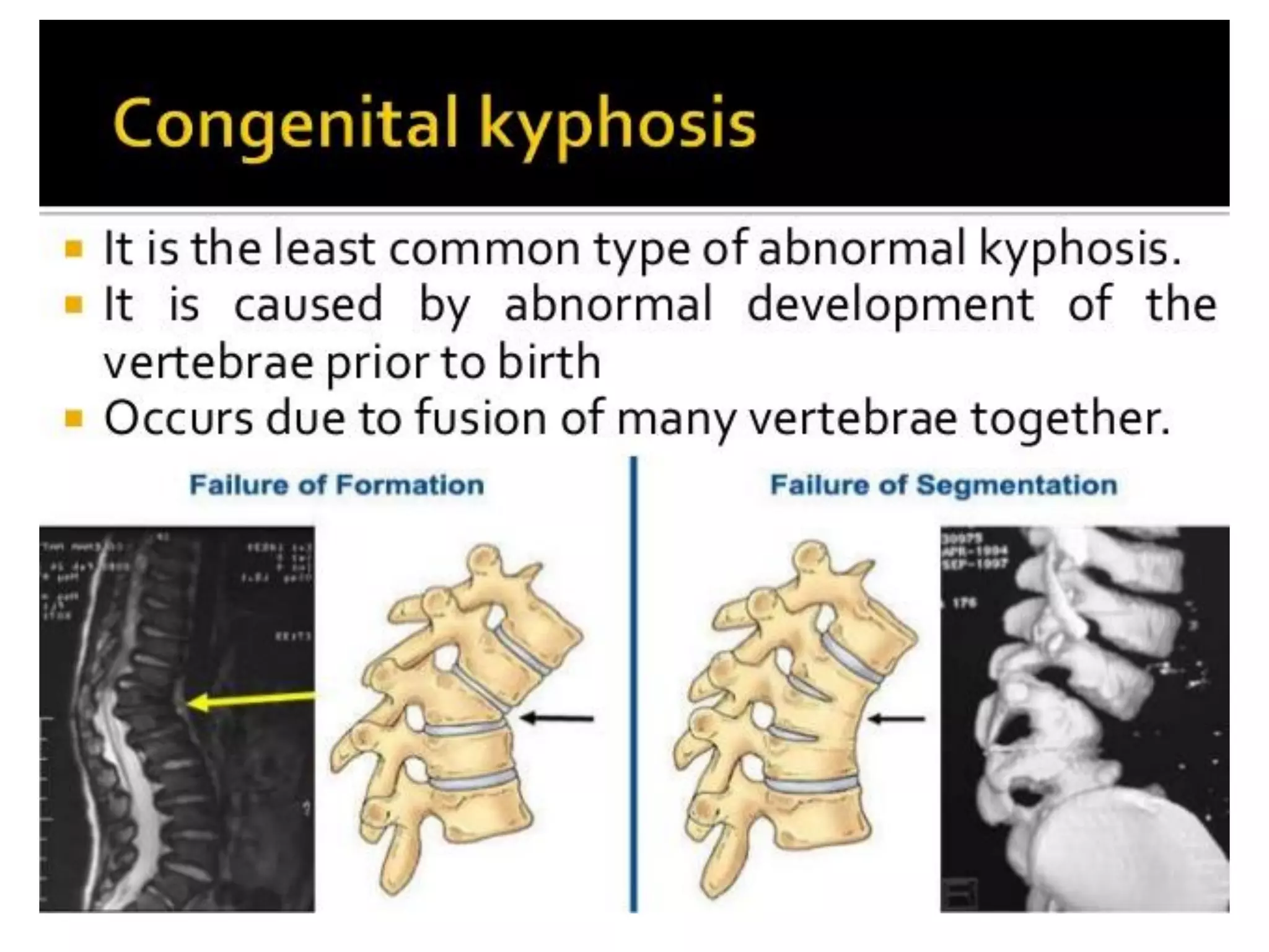 KYPHOSIS LORDOSIS.pdf