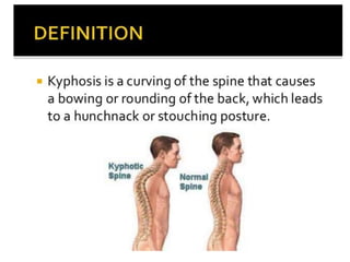 KYPHOSIS LORDOSIS.pdf
