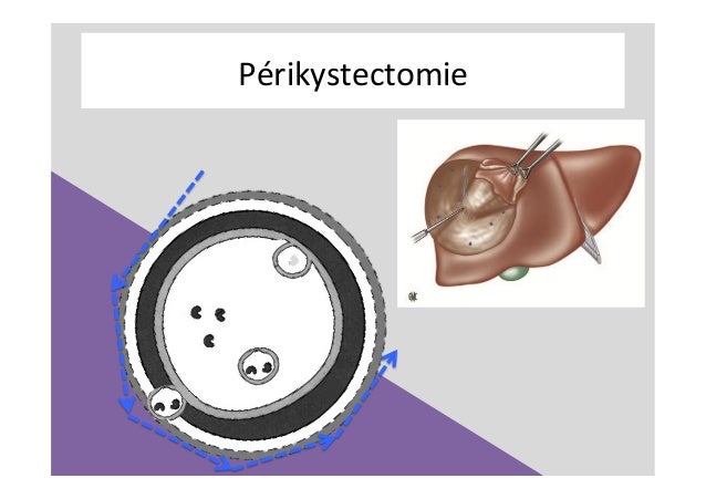 Kyste hydatique du foie