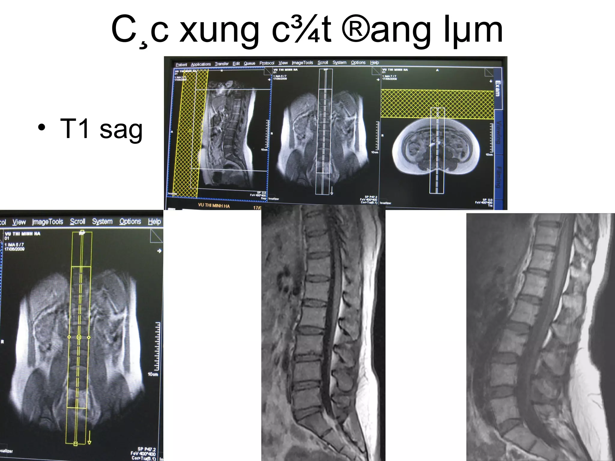 Ky thuat chup mri cstl | PPT