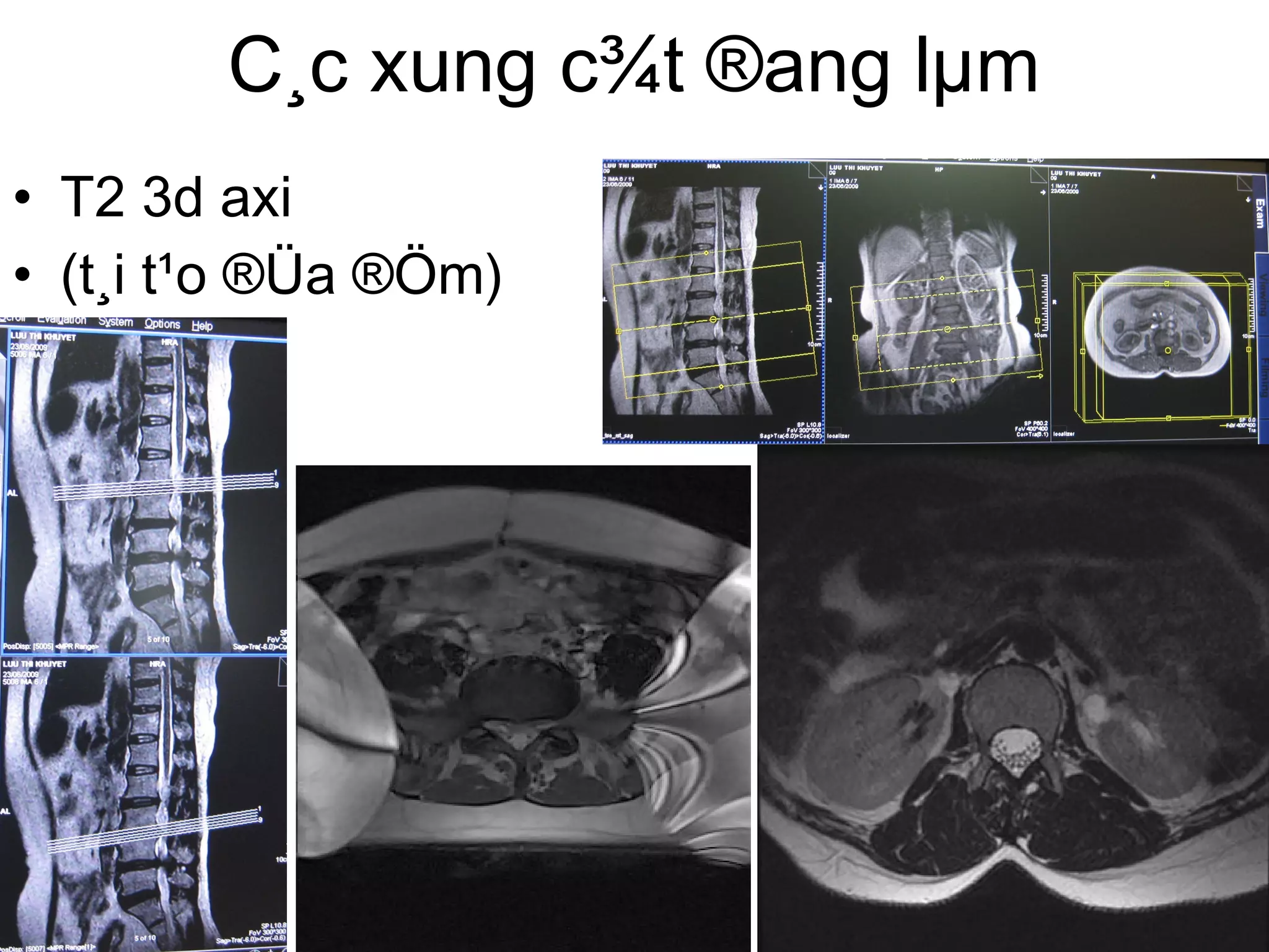 Ky thuat chup mri cstl | PPT