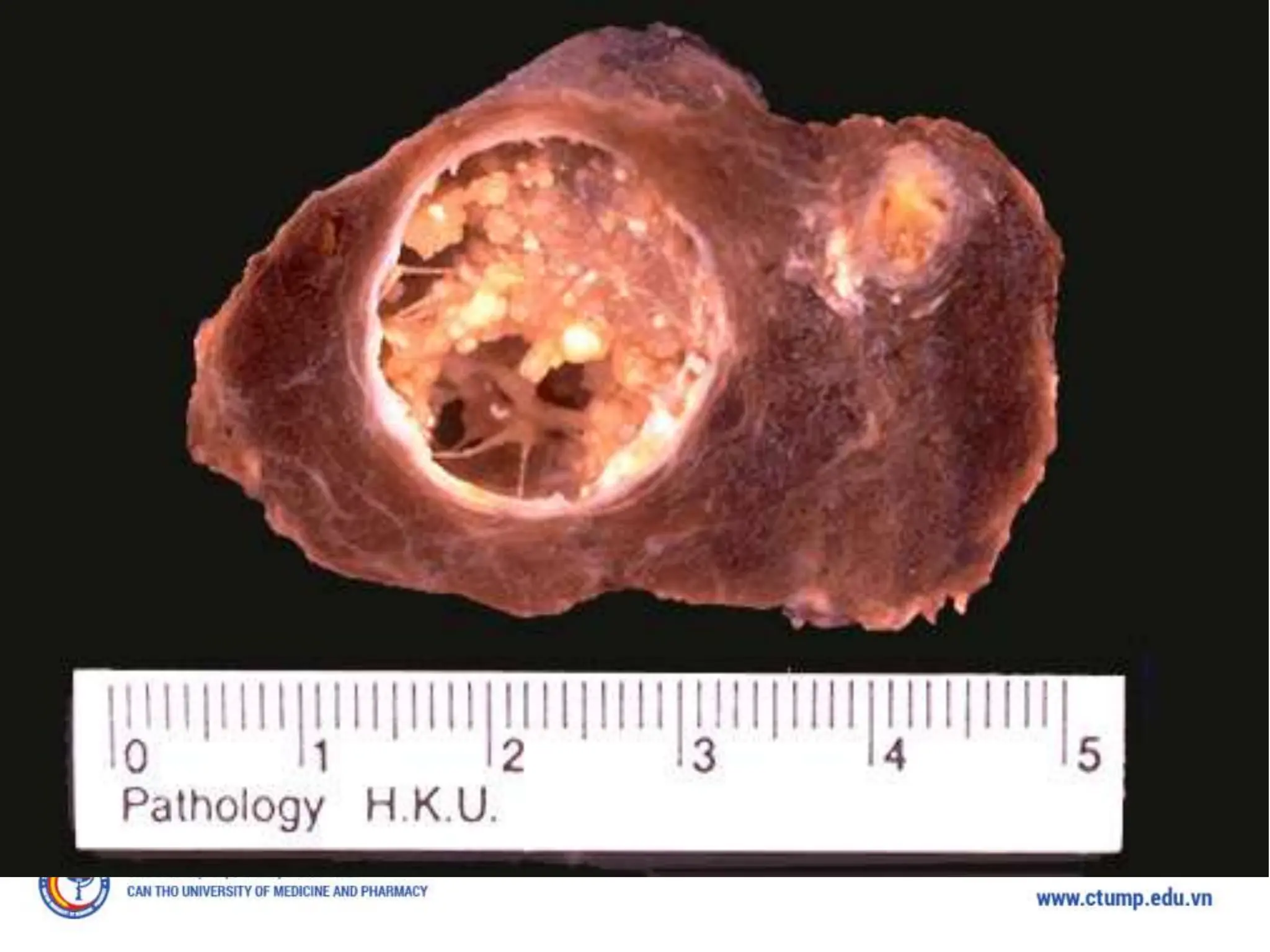 KY THUAT GIAI PHAU BENH PPT - HISTOPATHOLOGY TECHNIQUES - PATHOLOGY CTUMP NGUYEN PHUC DUY 2023 ...