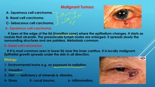 L-2 Eye lid disorder.pdf