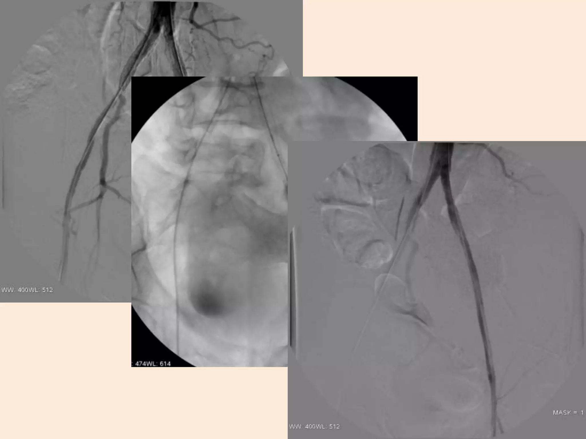 AORTO-ILIAC INTERVENTIONS | PPTX