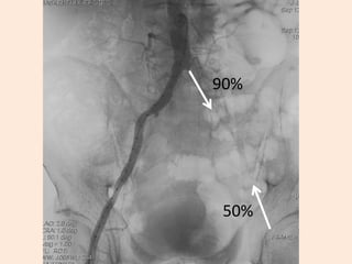 AORTO-ILIAC INTERVENTIONS | PPTX