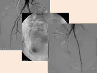 AORTO-ILIAC INTERVENTIONS | PPTX