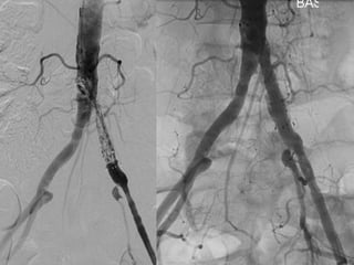 AORTO-ILIAC INTERVENTIONS | PPTX