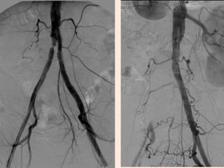 AORTO-ILIAC INTERVENTIONS | PPTX