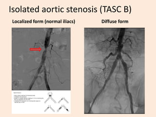 AORTO-ILIAC INTERVENTIONS | PPTX
