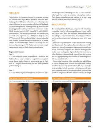 L shaped columellar strut in asian nose(asian rhinoplasty) | PDF