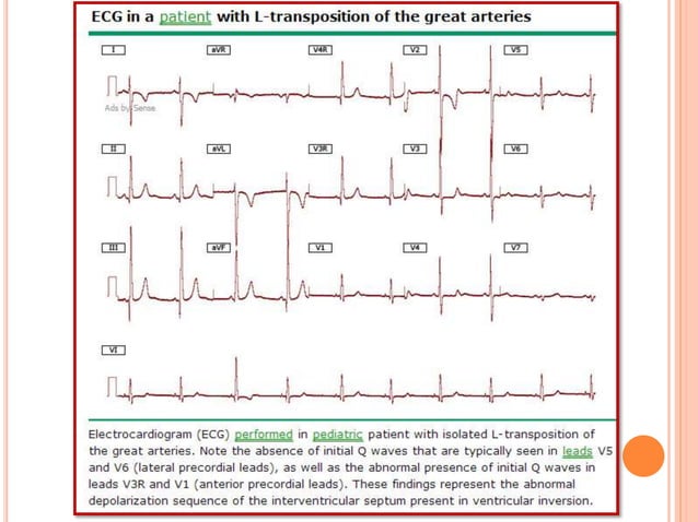 L-TGA or CCTGA | PPT