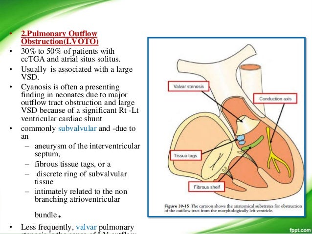 Lvot Obstruction