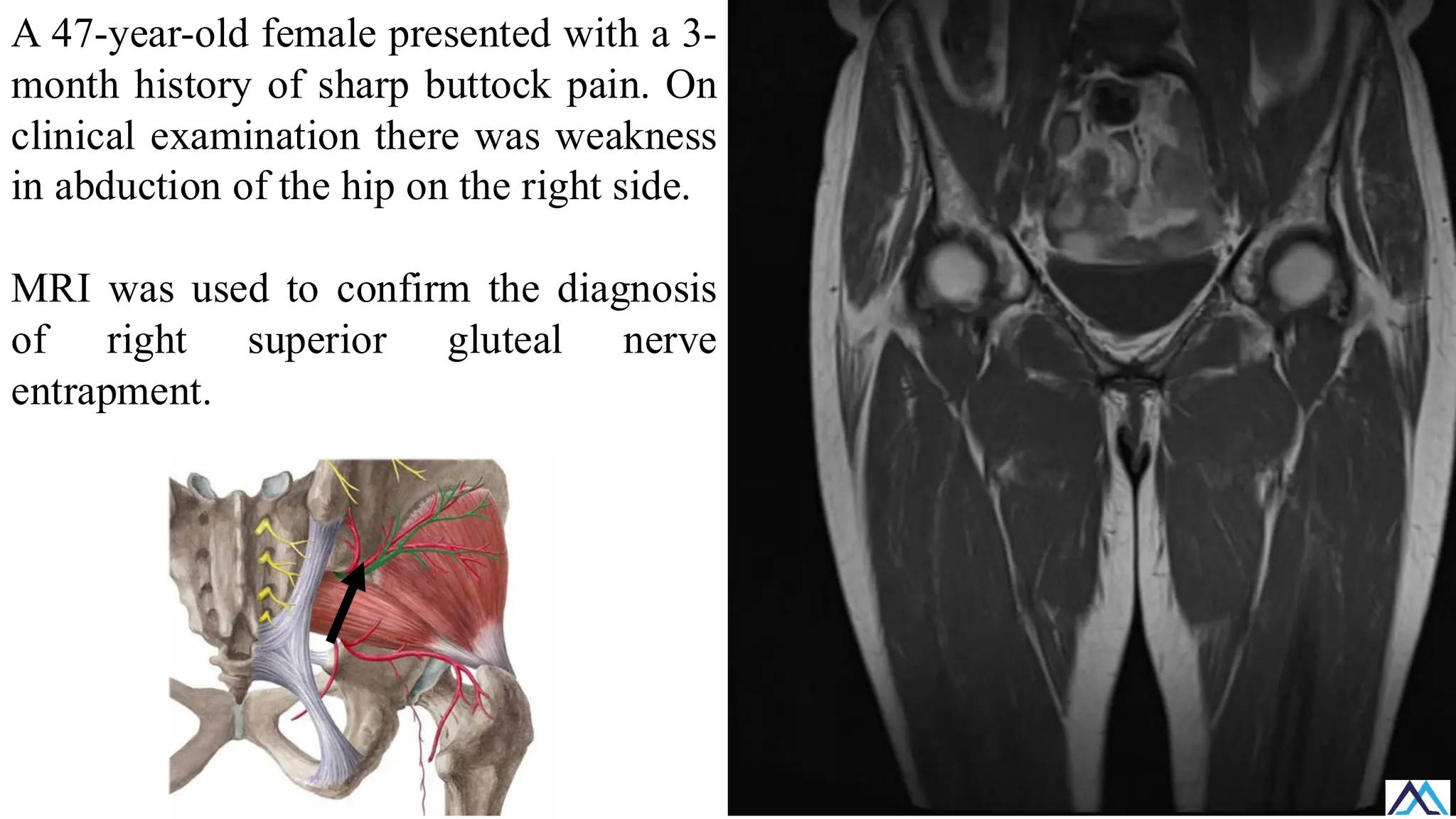 Gluteus Maximus Anatomy Mri