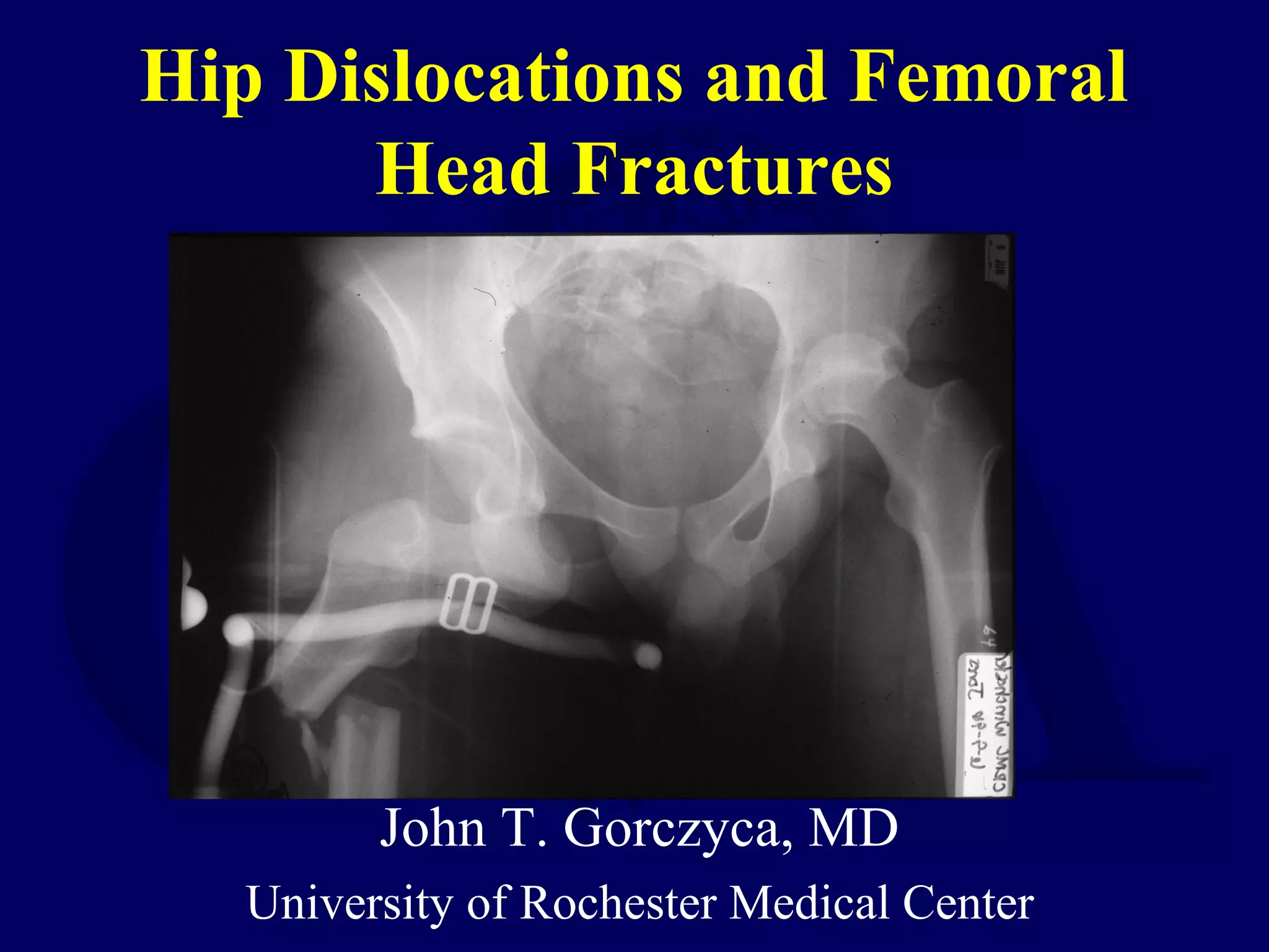 L01 hip dislocation, pipkin | PPT