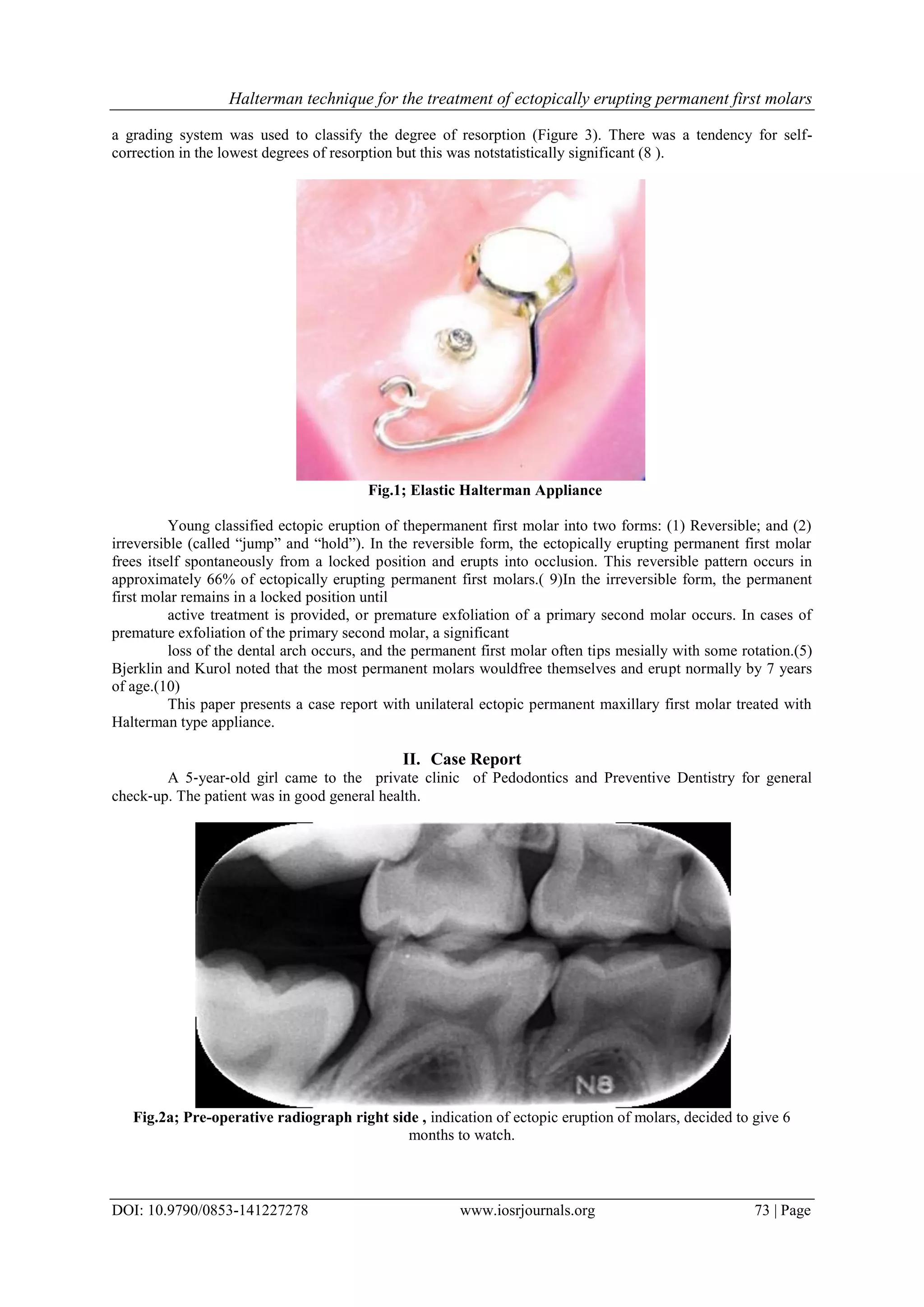 Halterman technique for the treatment of ectopically erupting permanent ...