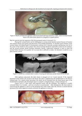 Halterman technique for the treatment of ectopically erupting permanent ...