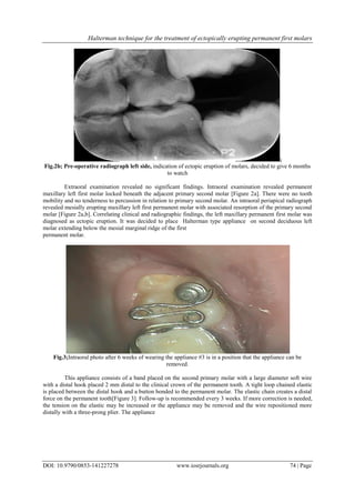 Halterman technique for the treatment of ectopically erupting permanent ...