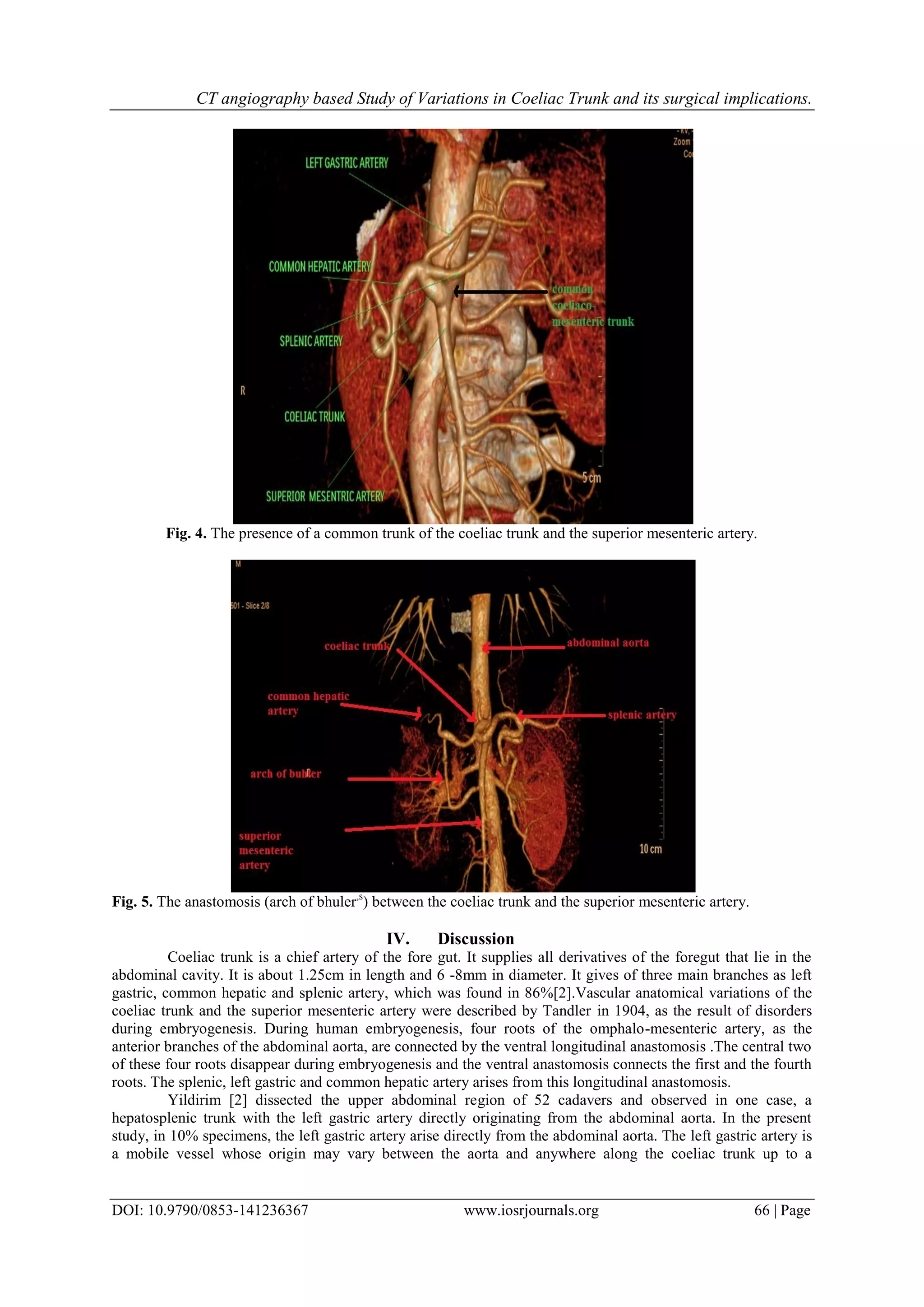 CT angiography based Study of Variations in Coeliac Trunk and its ...